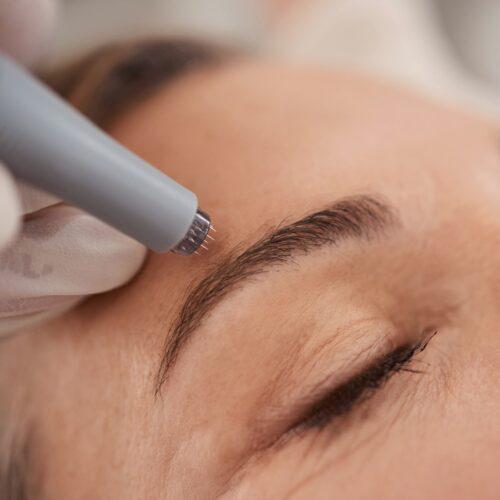Microneedling: A Revolution in Skin Therapy - Forest Park Wellness